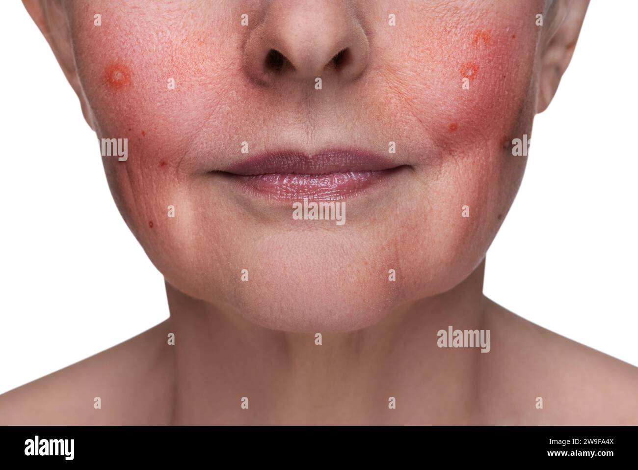 Woman with rosacea on white background, closeup. Problem skin treatment ...