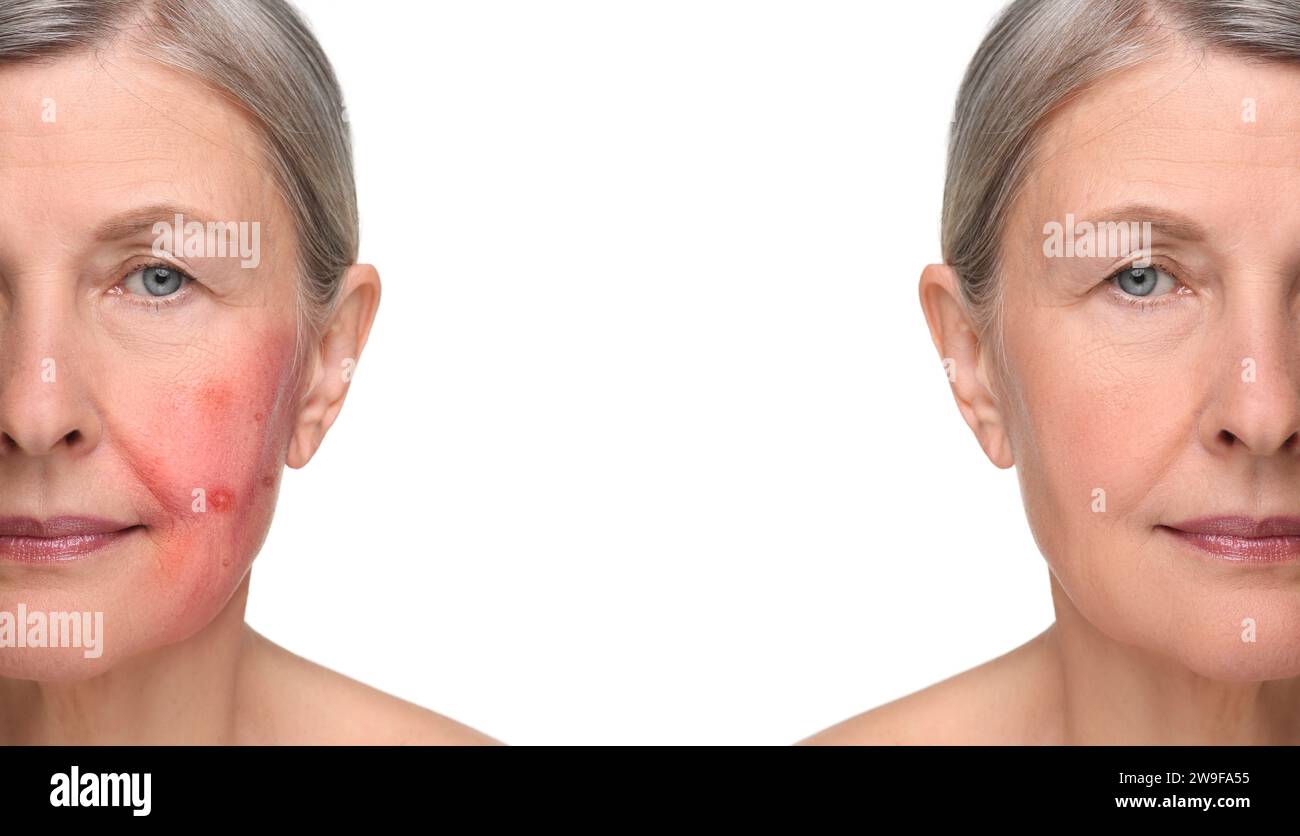 Before and after rosacea treatment. Photos of woman on white background ...
