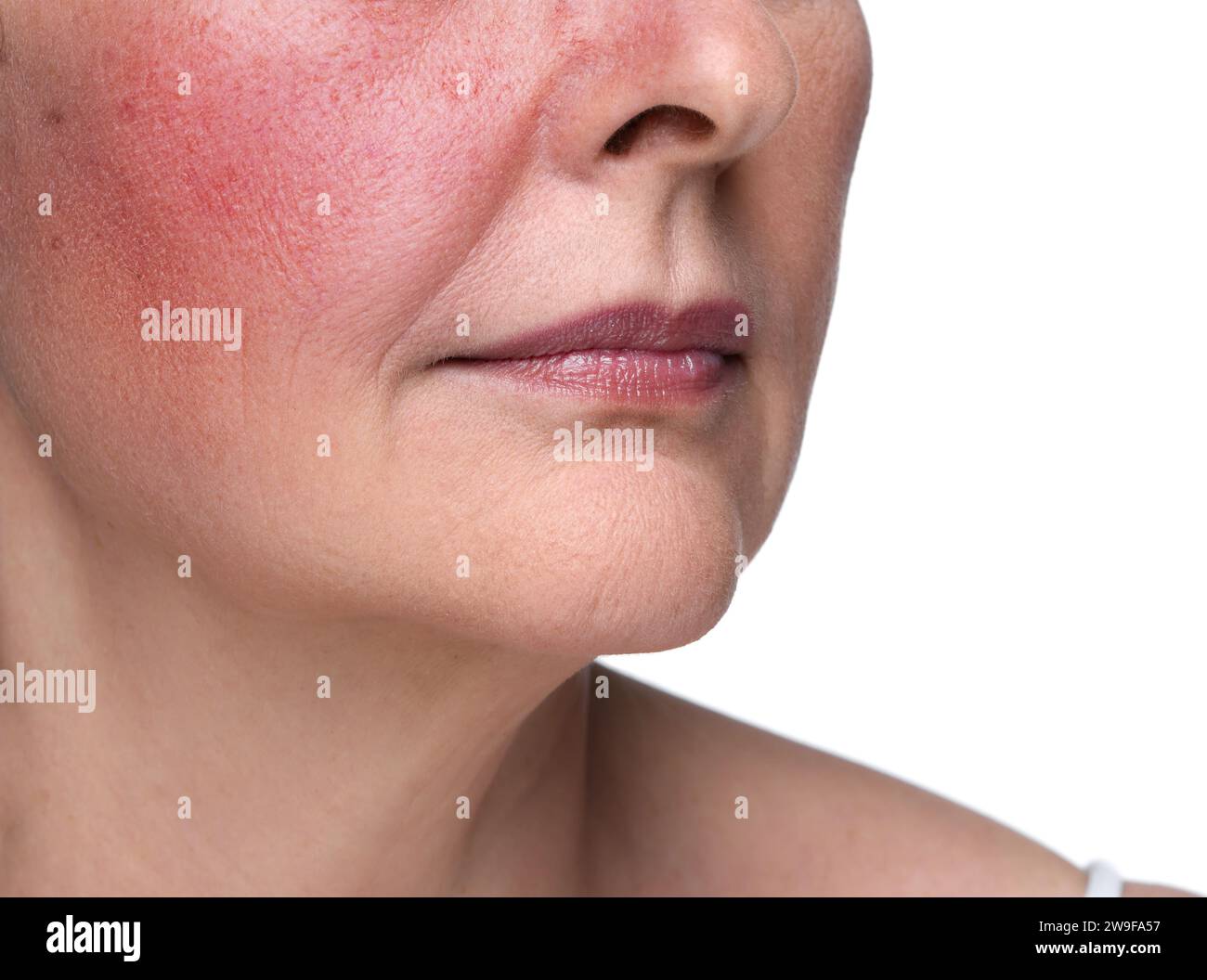 Woman with rosacea on white background, closeup. Problem skin treatment ...