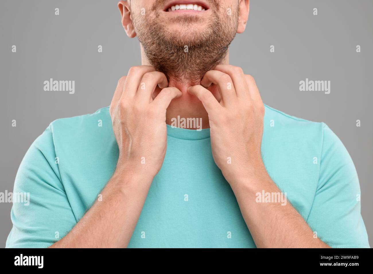Man scratching neck rash hi-res stock photography and images - Alamy