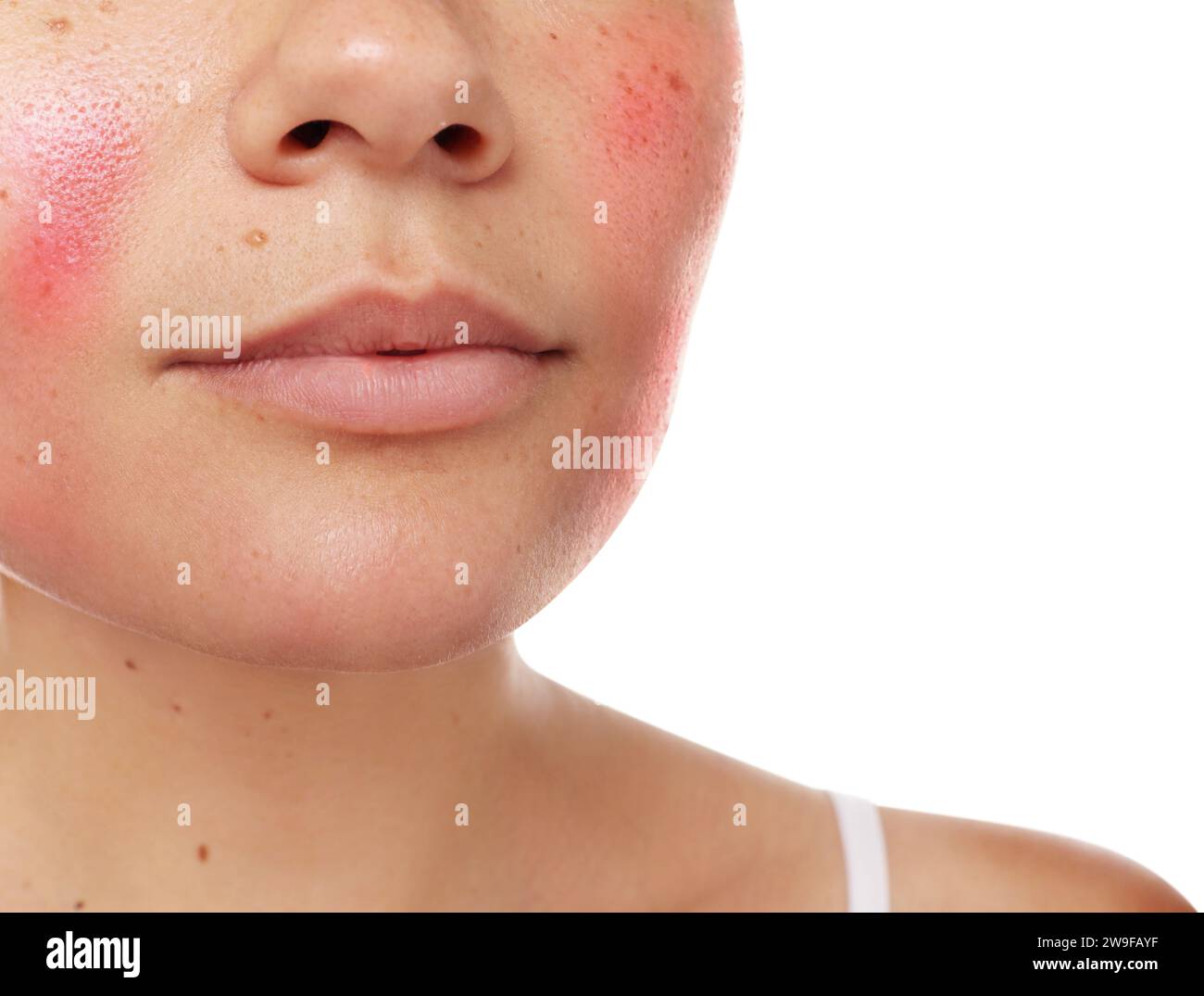 Woman with rosacea on white background, closeup. Problem skin treatment ...