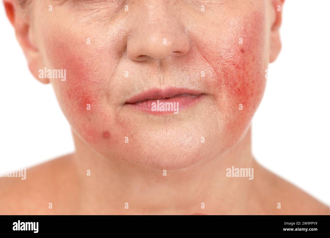 Woman with rosacea on white background, closeup. Problem skin treatment ...