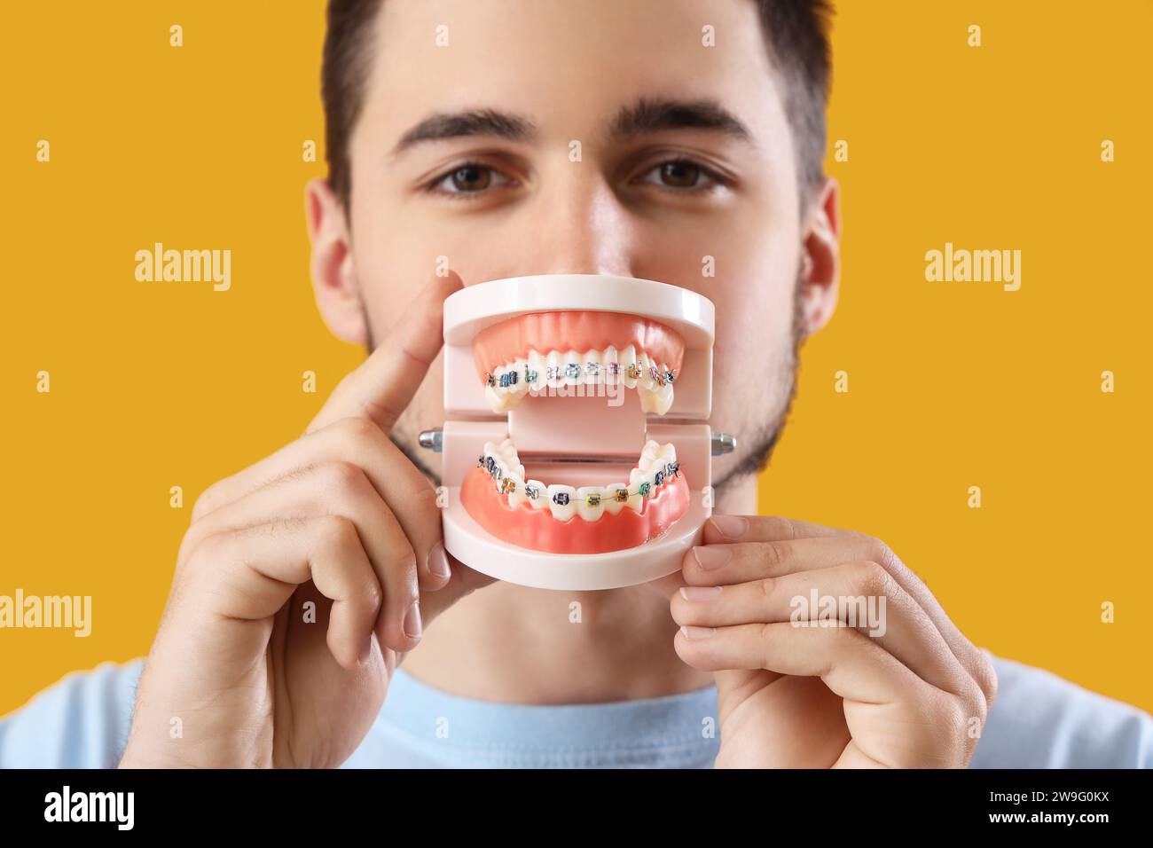 Handsome young man holding model of jaw with dental braces on yellow ...