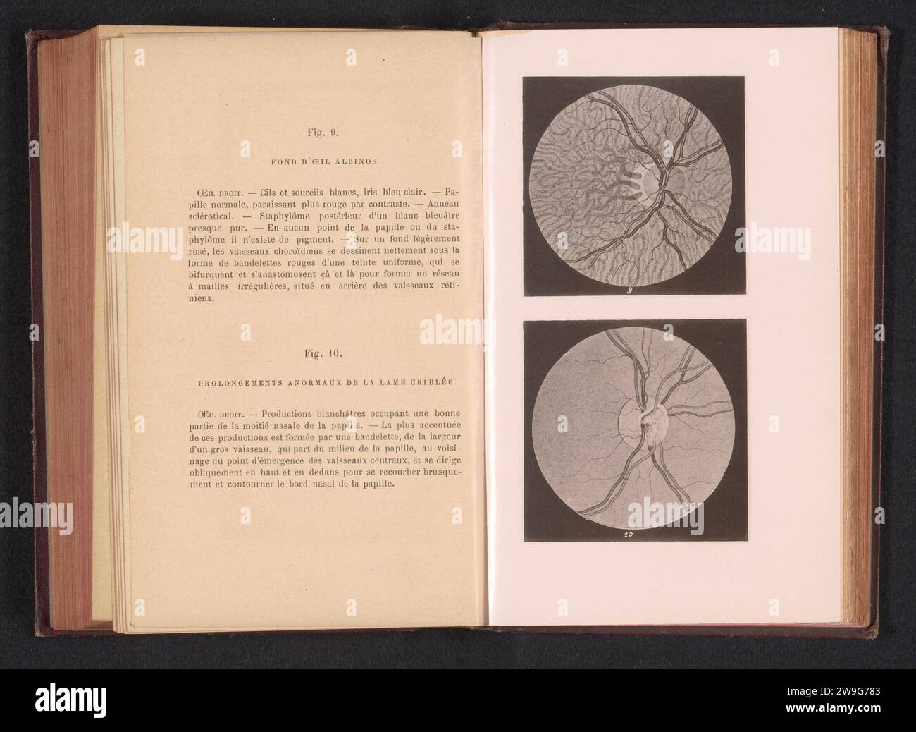 Photo production of two anatomical drawings of an eye of someone with ...