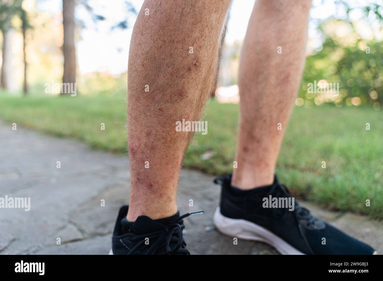 Close-up of a man leg with dermatitis scratching the blisters. Redness ...