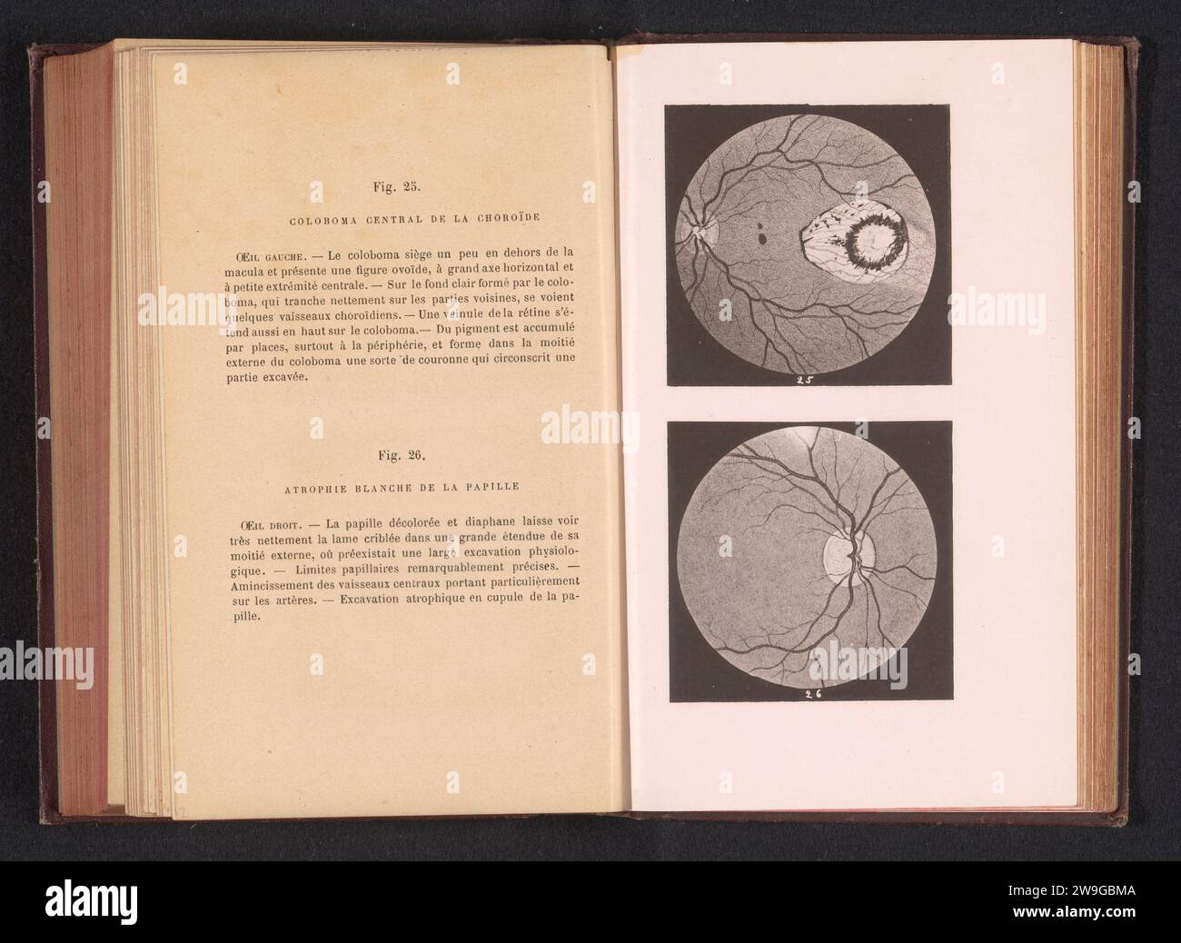 Photo production of two anatomical drawings of a hole in the vascular ...