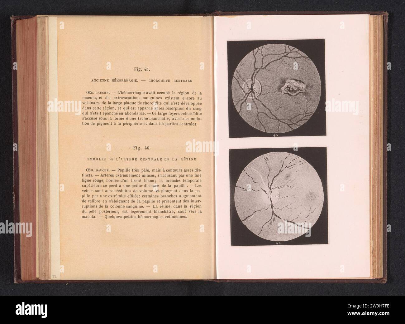Photo production of two anatomical drawings of bleeding and embolism in ...
