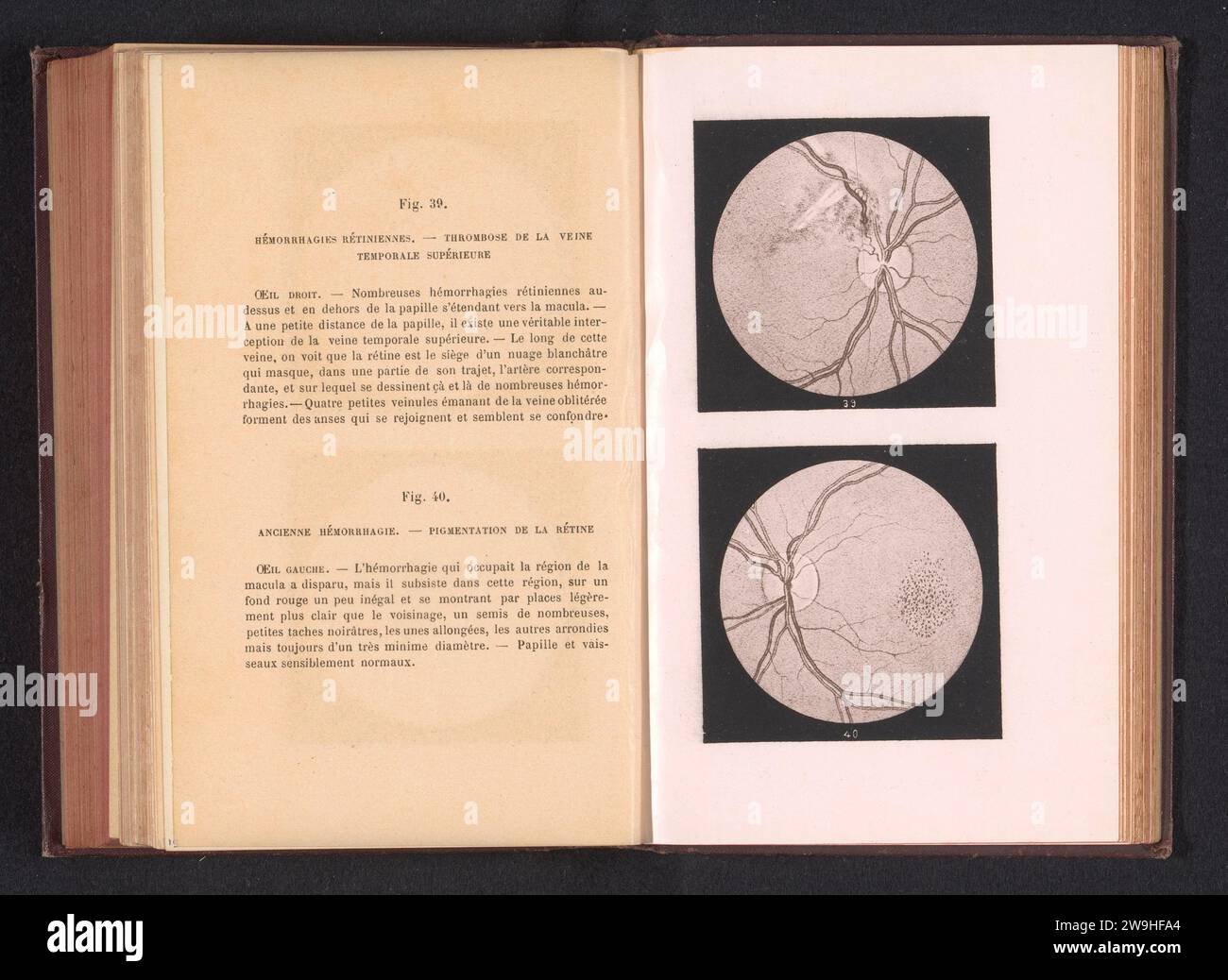 Photo production of two anatomical drawings of bleeding at an eye ...