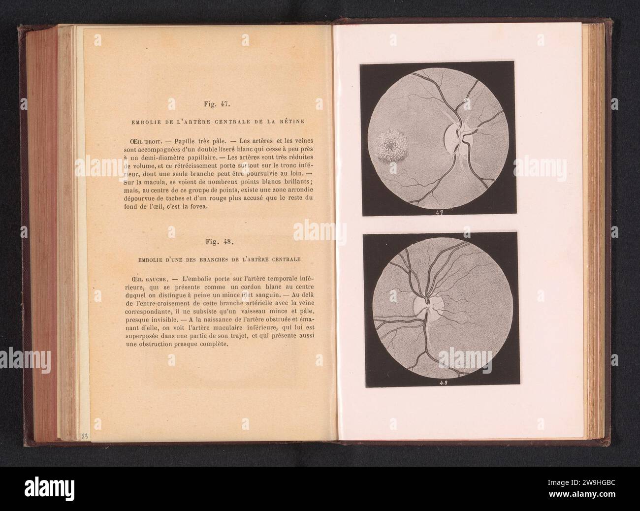 Photo production of two anatomical drawings of embolism in an eye ...