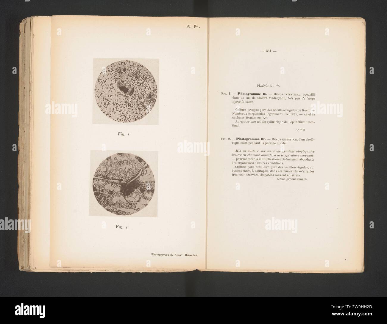Two microscope recordings of the intestinal mucosa of someone who died ...