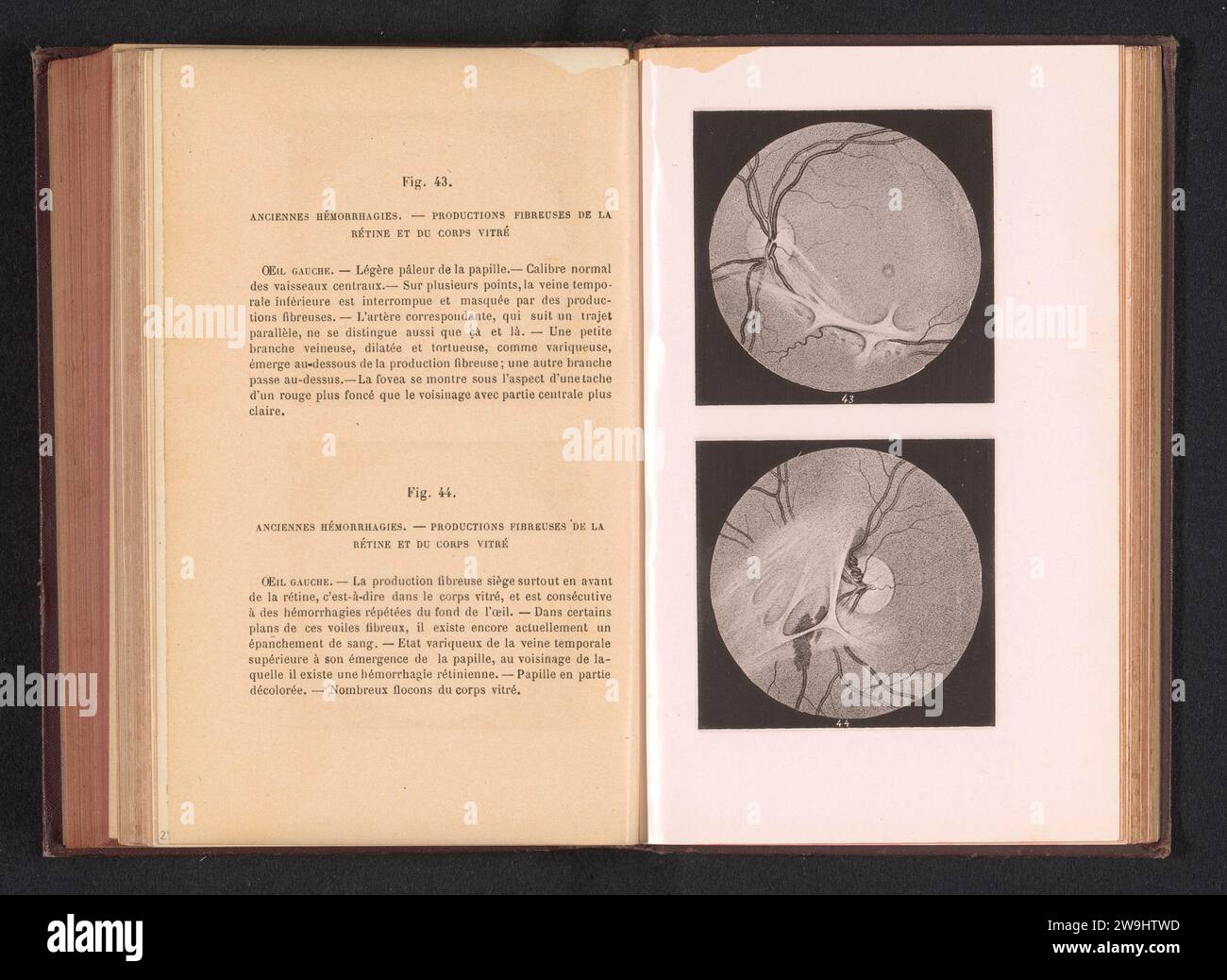 Photo production of two anatomical drawings of bleeding at an eye ...