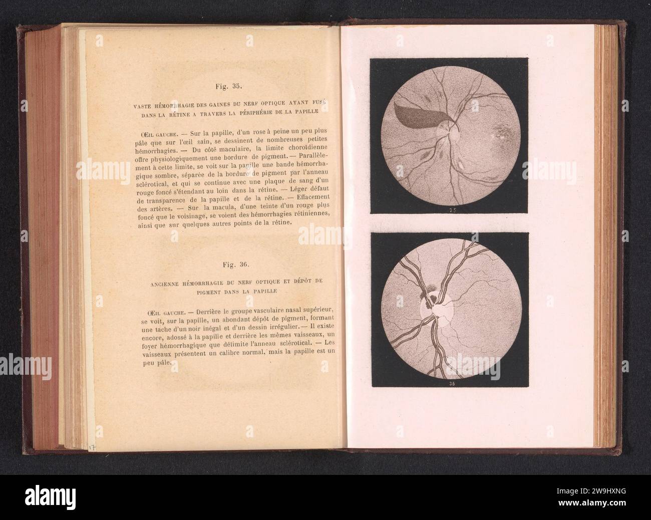 Photo production of two anatomical drawings of bleeding at an eye ...
