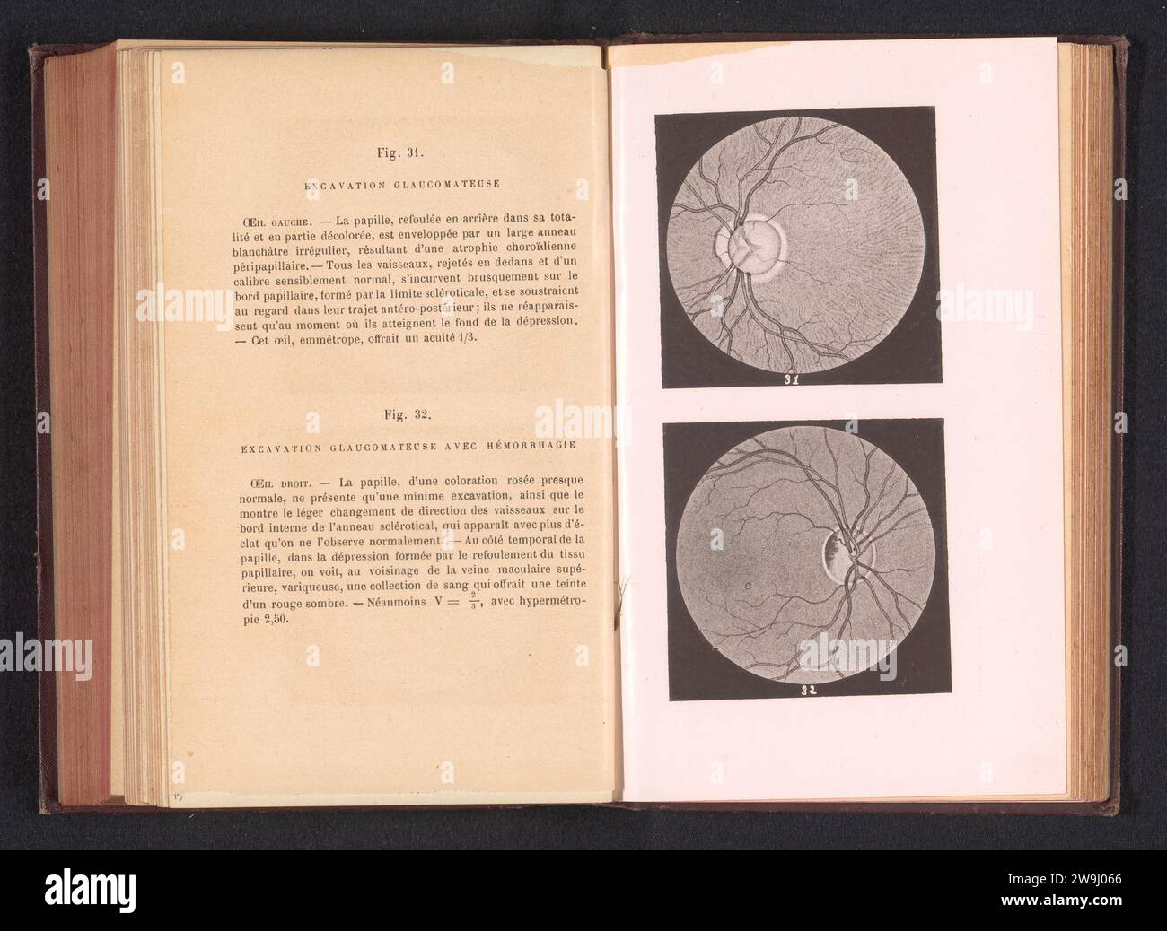Anatomical distortion hi-res stock photography and images - Alamy