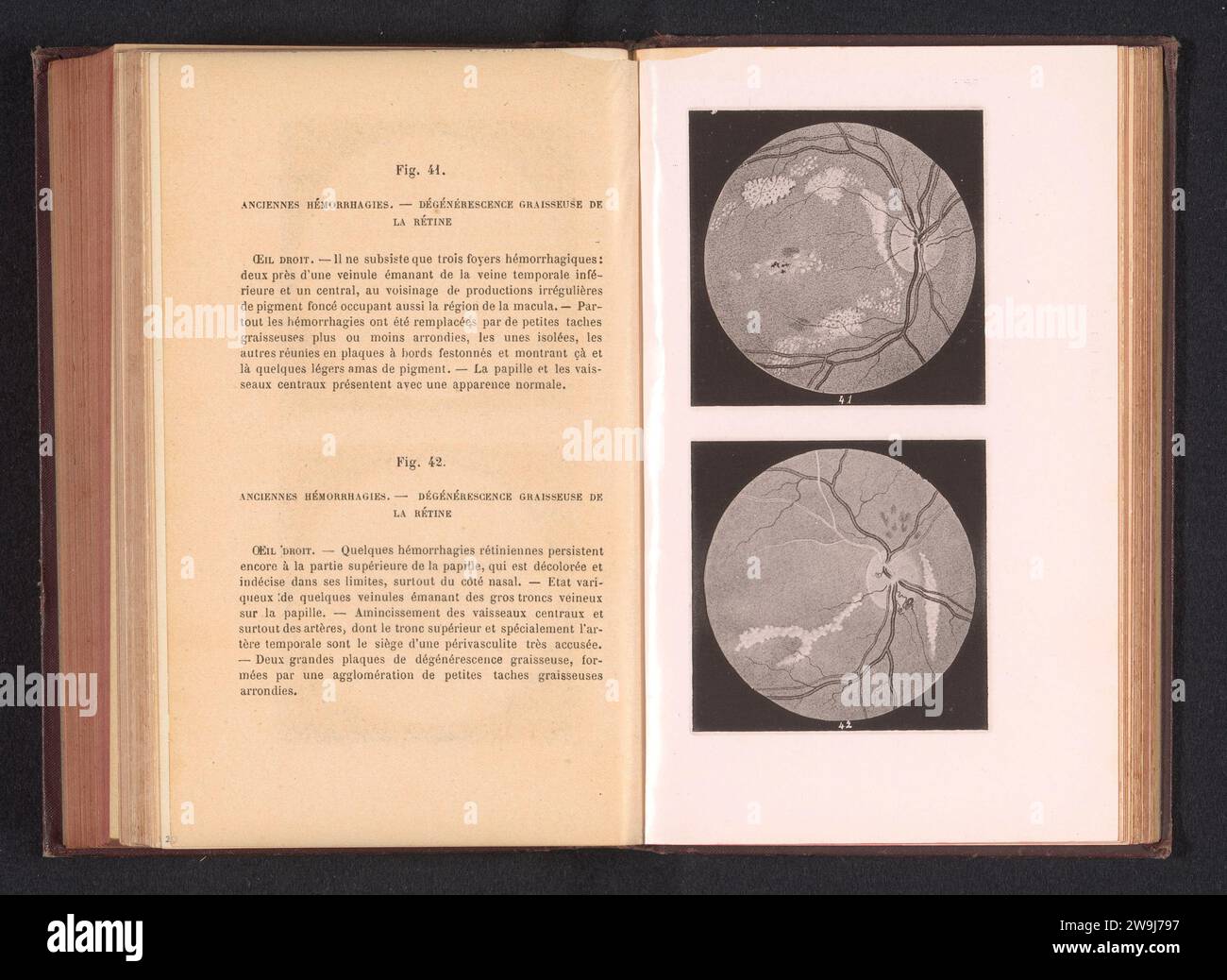 Photo production of two anatomical drawings of bleeding at an eye ...