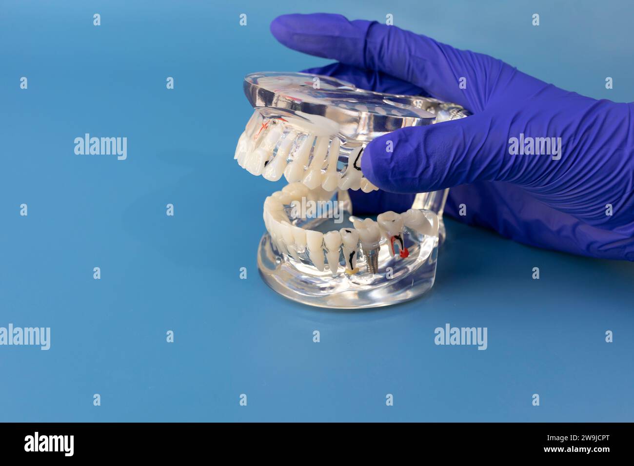 Dentist's Hand Holds Study Standard Typodont or Periodontal Disease ...