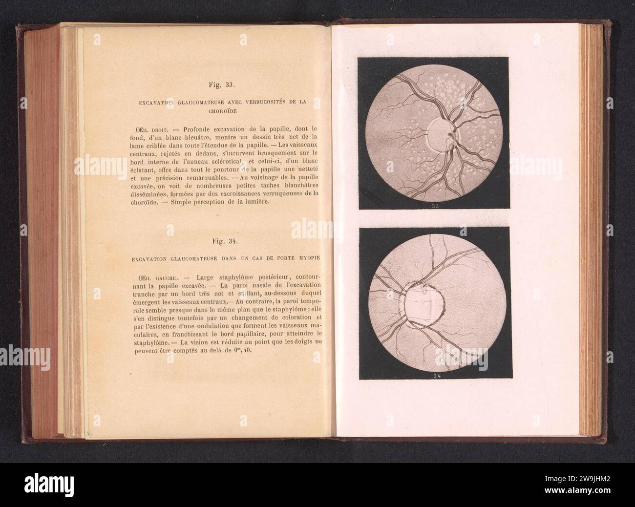 Photo production of two anatomical drawings of an eye by glaucoma ...