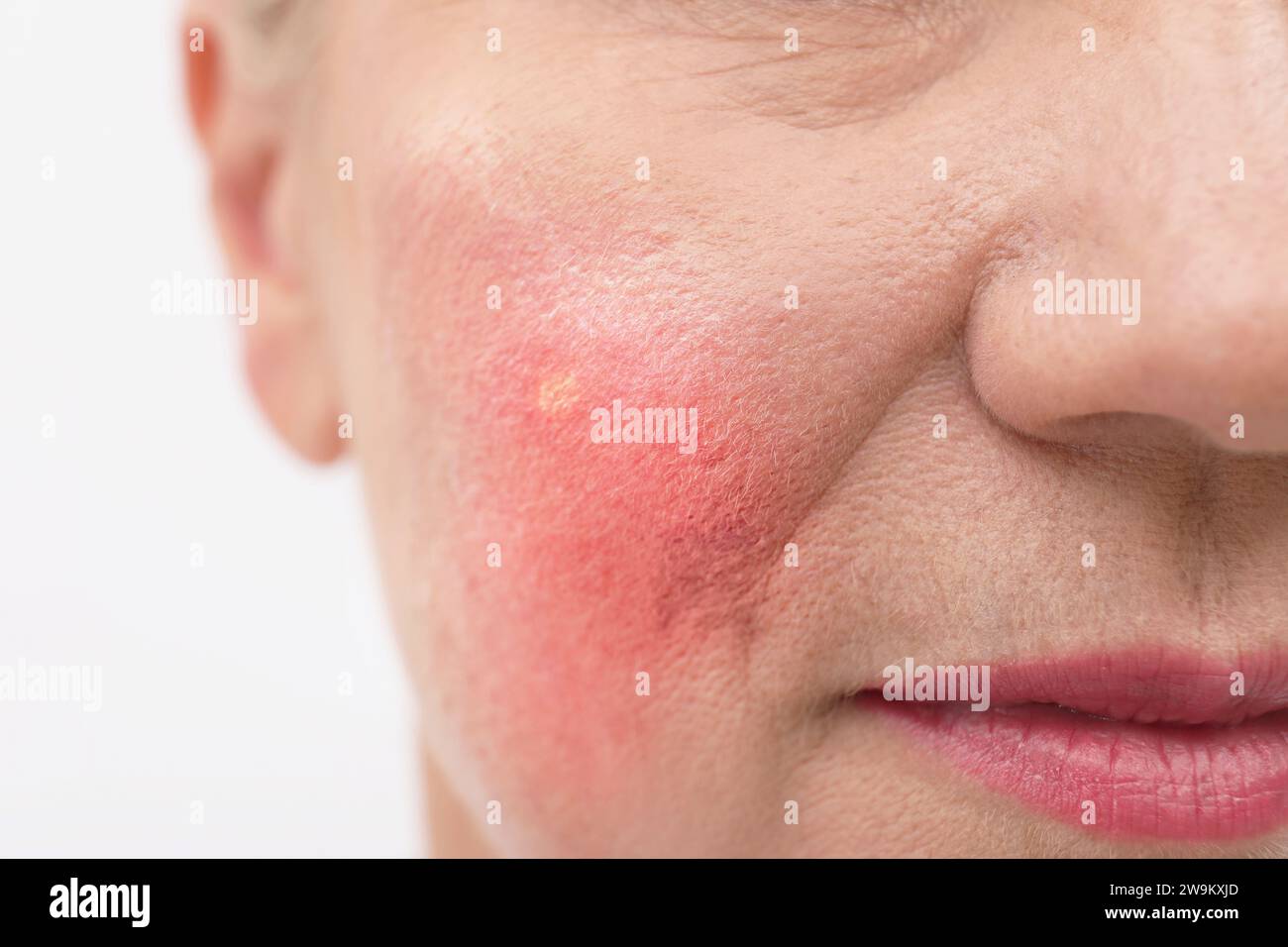 Woman with rosacea on white background, closeup. Problem skin treatment ...