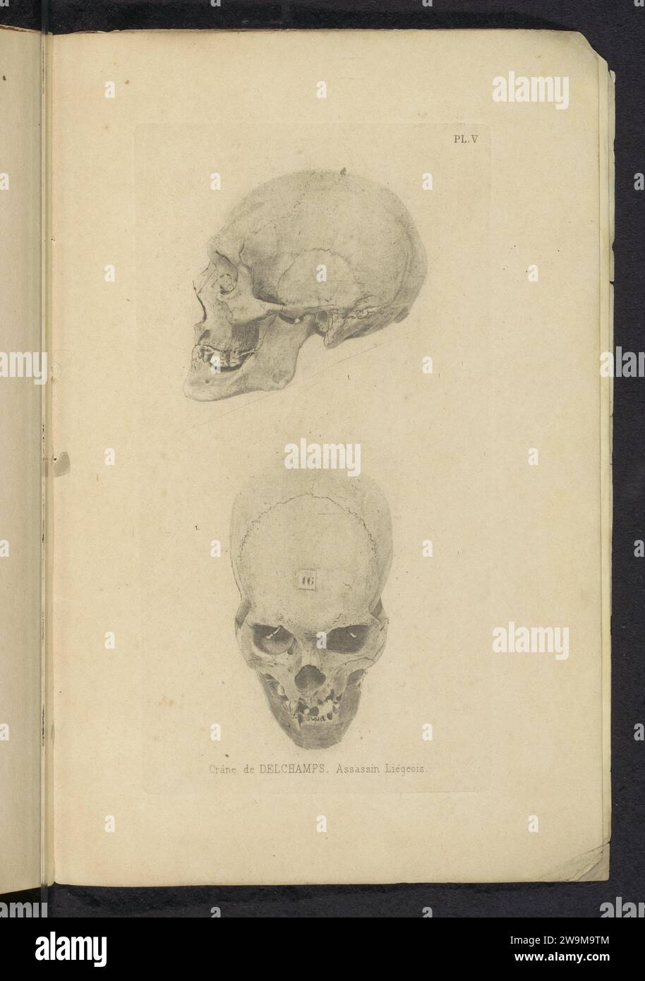 Two views of a skull, anonymous, c. 1871 - In or Before 1881 ...