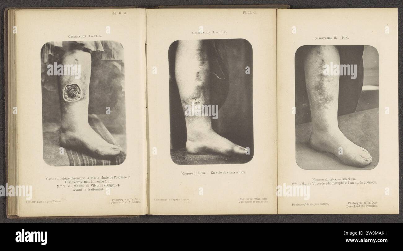 Necrotic wound hi-res stock photography and images - Alamy