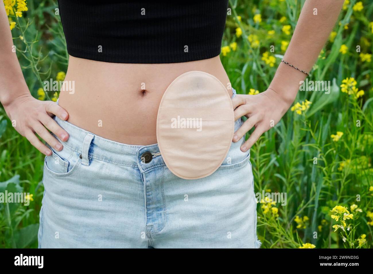 close-up of woman body after of colon cancer in springtime. Ostomy bag ...
