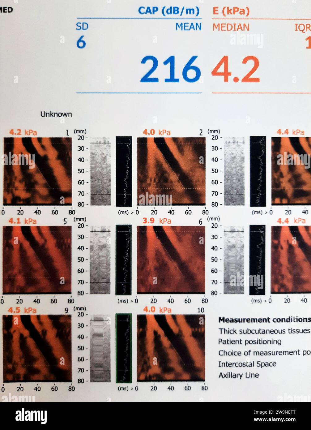 Fibroscan examination study of the liver revealed F0 for liver ...
