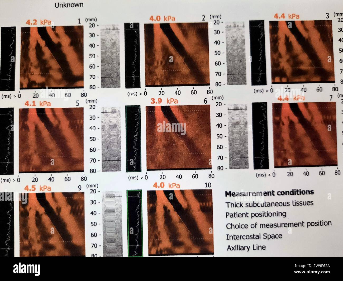 Fibroscan examination study of the liver revealed F0 for liver ...