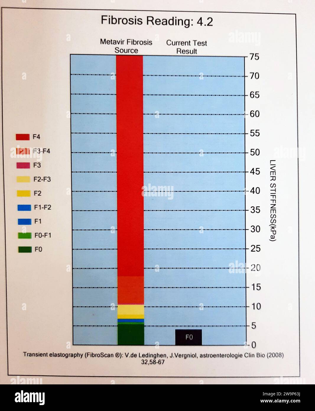 Cairo, Egypt, November 7 2023: Fibroscan examination study of the liver ...