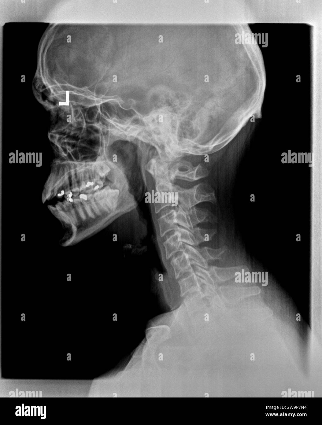 Normal neck x ray hi-res stock photography and images - Alamy