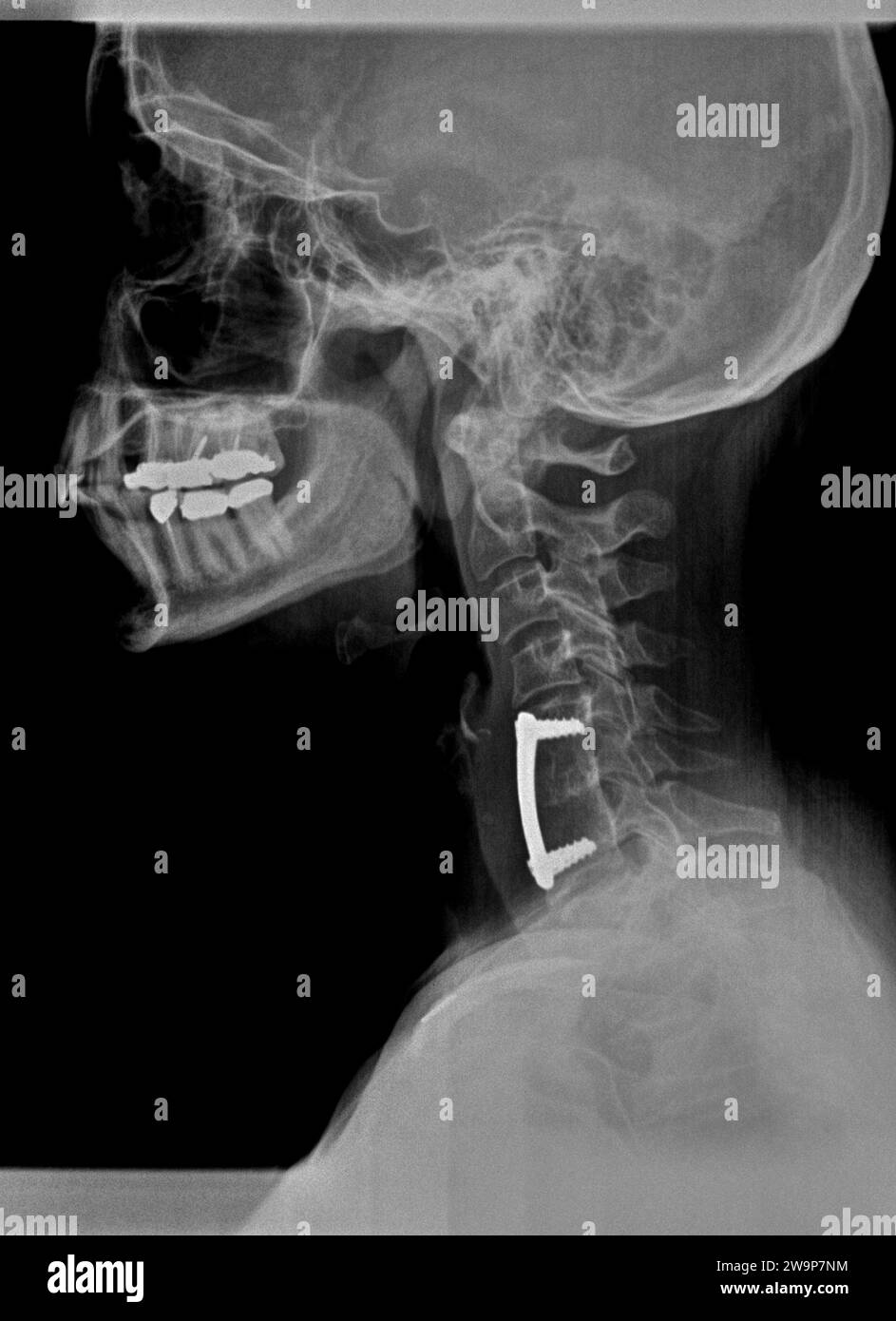 Film xray or radiograph of a cervical neck. Lateral side view showing ...