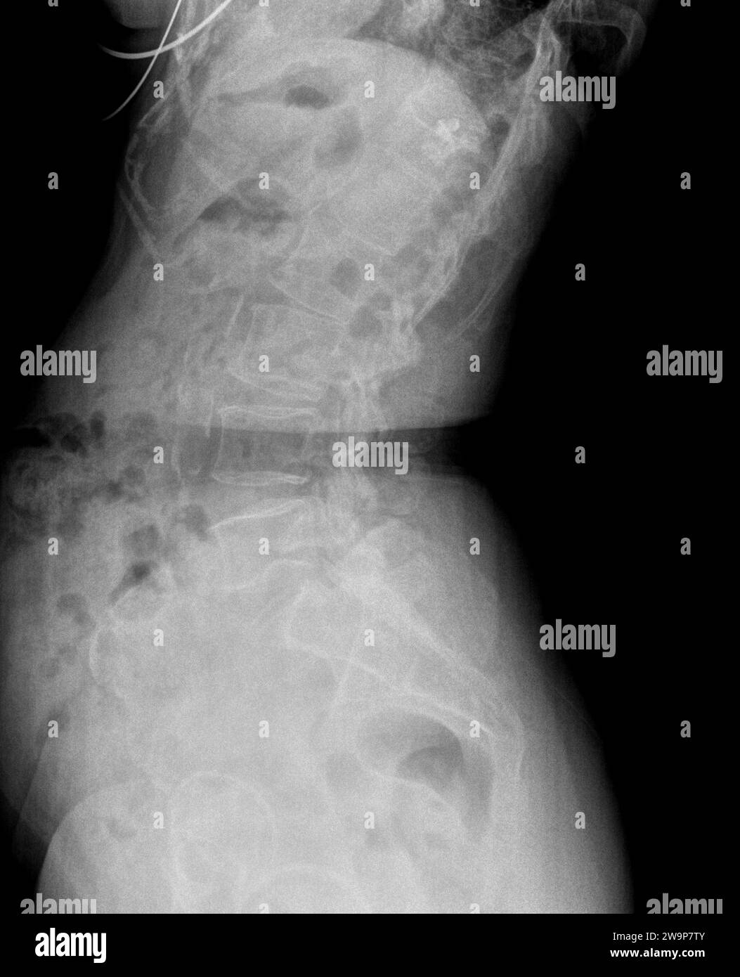 X ray normal lumbar spine hi-res stock photography and images - Alamy