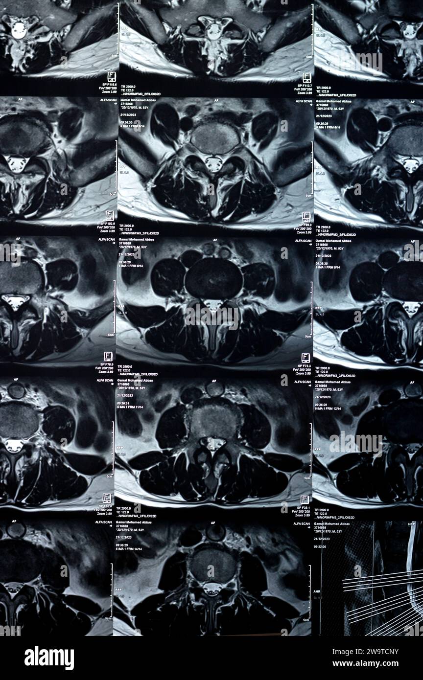 Cairo, Egypt, December 24 2023: L5 Vertebrae Spinal laminectomy ...