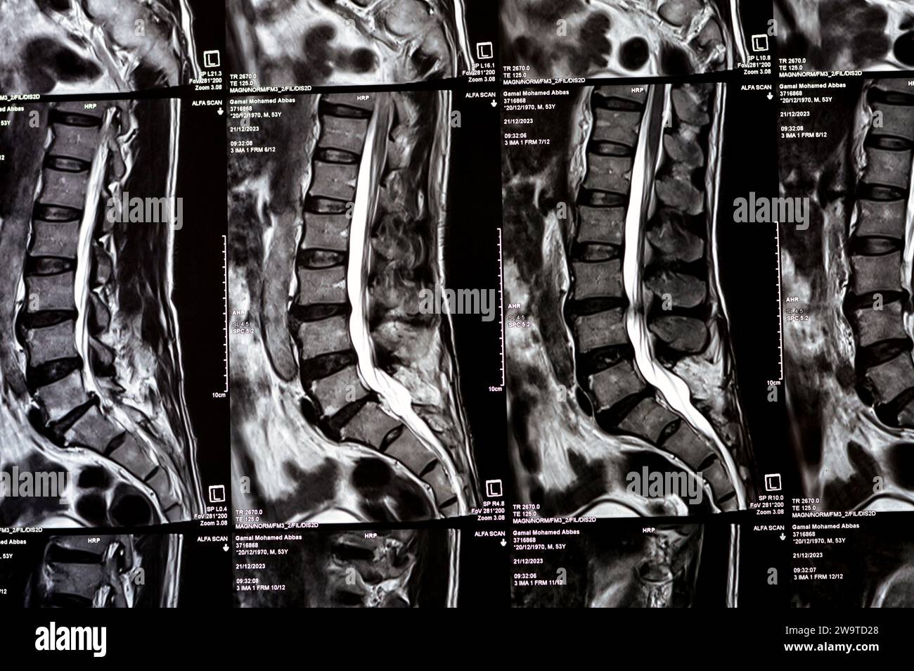 Cairo, Egypt, December 24 2023: L5 Vertebrae Spinal laminectomy ...
