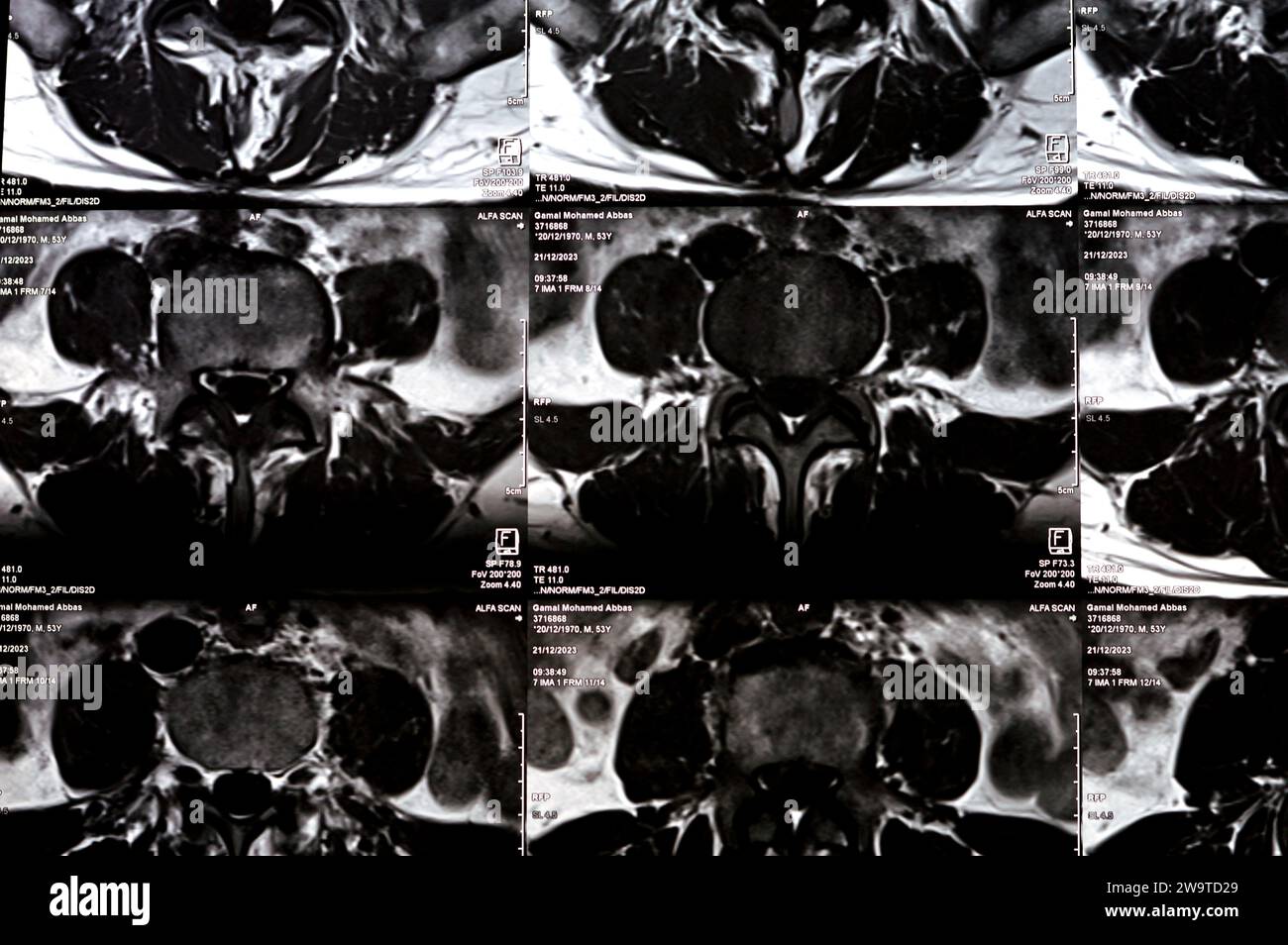 Cairo, Egypt, December 24 2023: L5 Vertebrae Spinal laminectomy ...