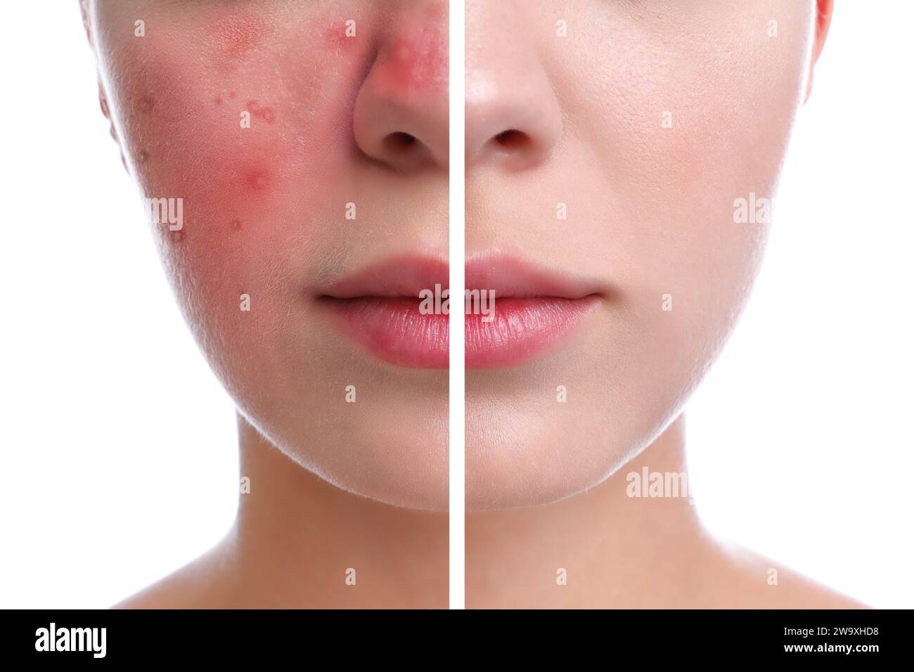 Before and after rosacea treatment. Photos of woman on white background ...