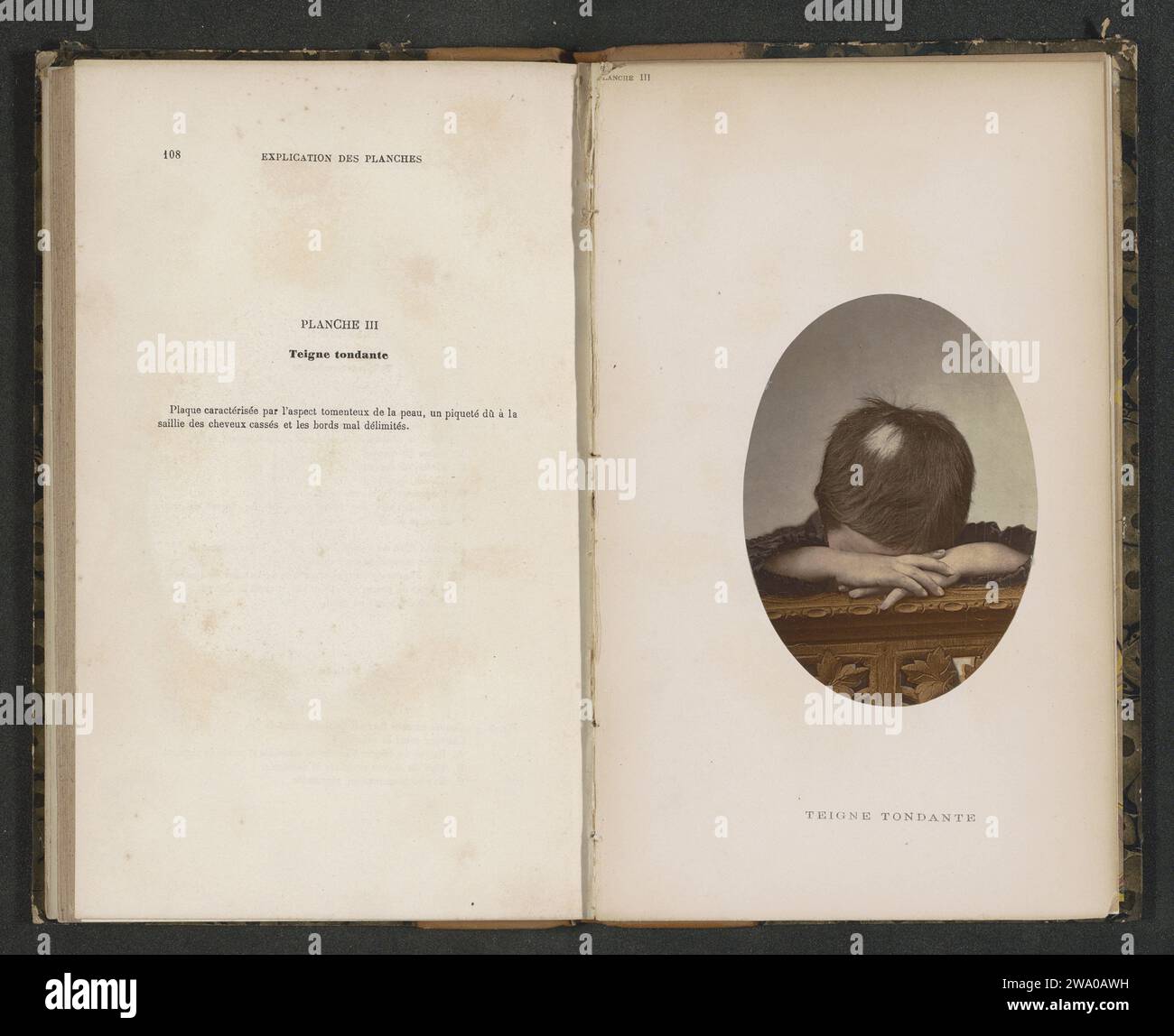 Bald spot on the head of a child caused by ringworm, anonymous, c. 1868 ...