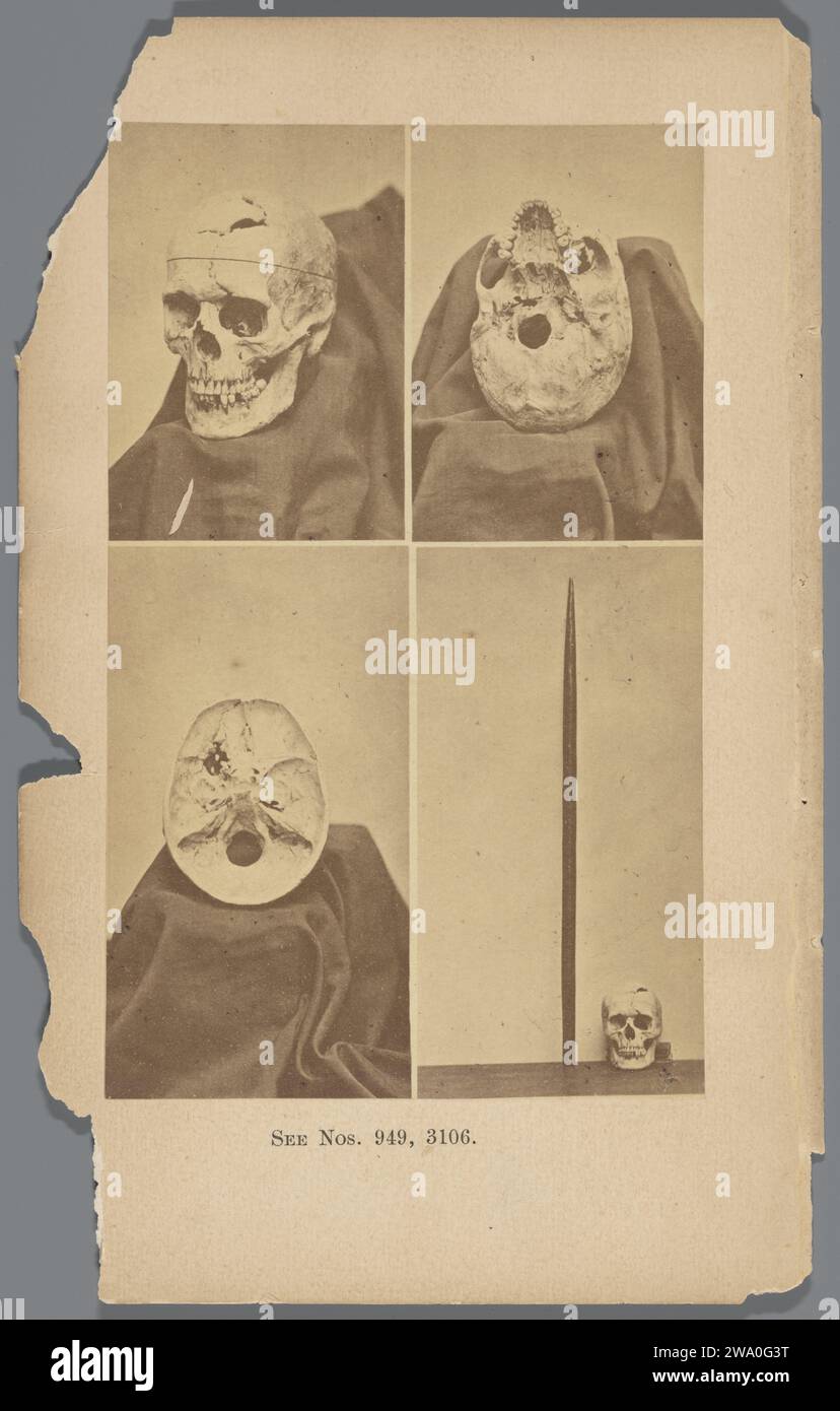 Four views of the skull of Phineas Gage, Anonymous, 1868 photograph ...