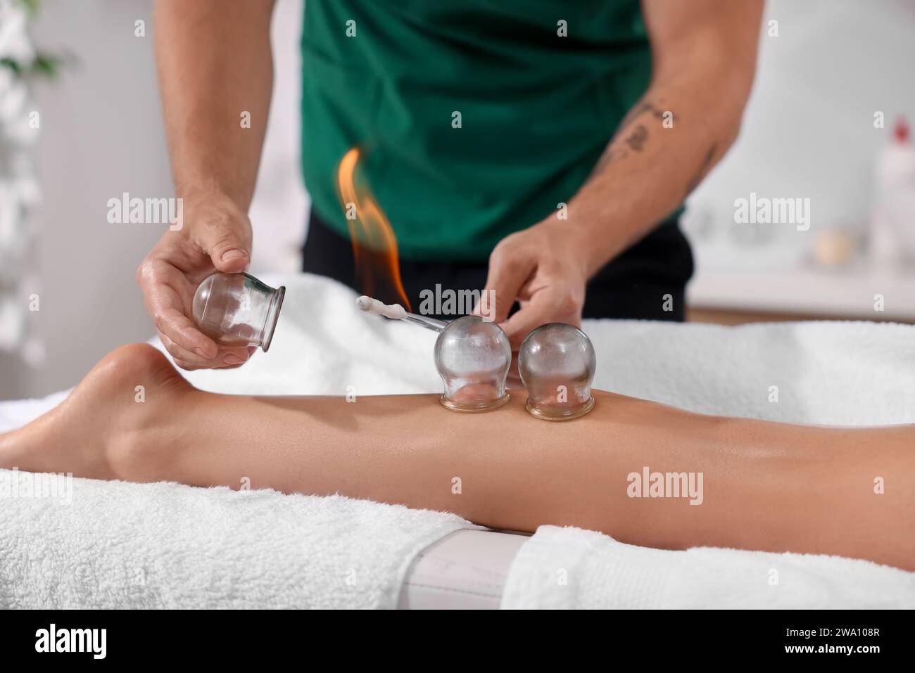Therapist giving fire cupping treatment to patient indoors, closeup ...