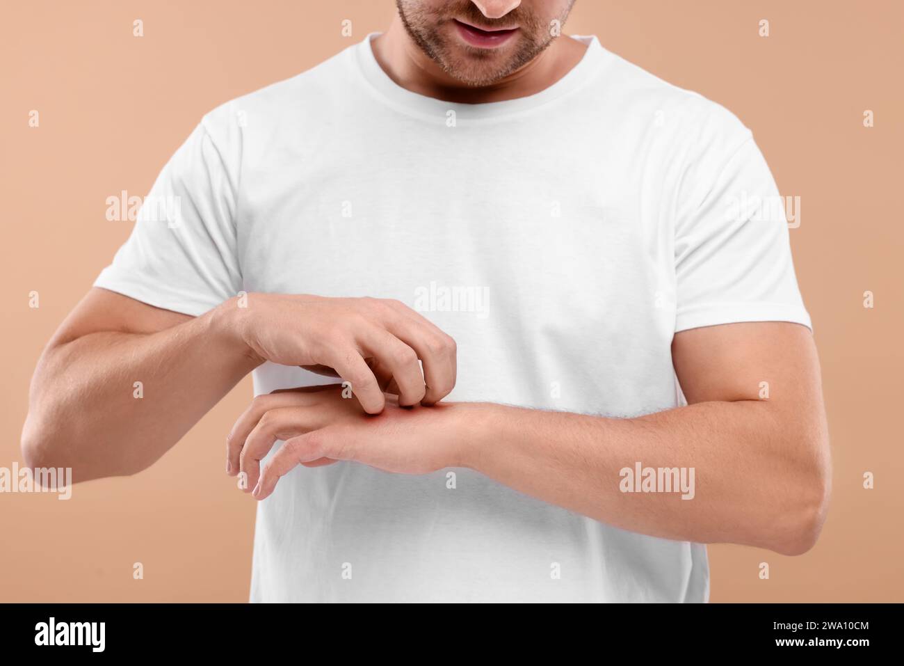 Allergy symptom. Man scratching his hand on light brown background ...