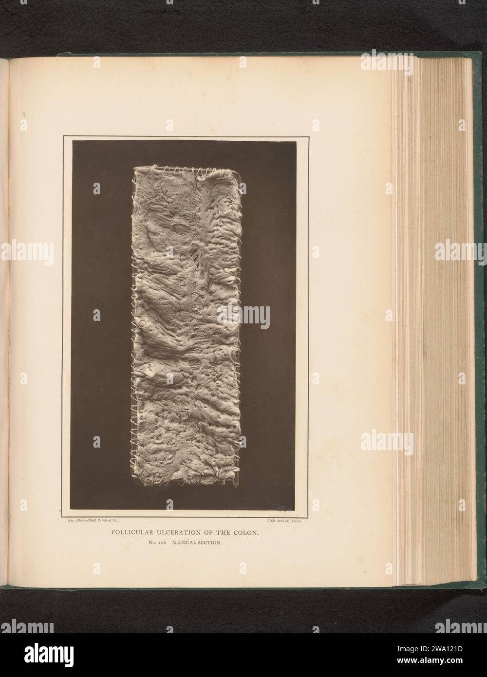 Stretched piece of colon with swollen cavities, E.J. Ward, c. 1874 - in ...