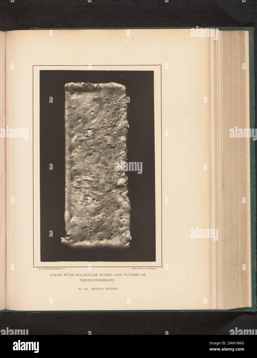 Stretched piece of colon with swollen cavities and membranes, E.J. Ward ...