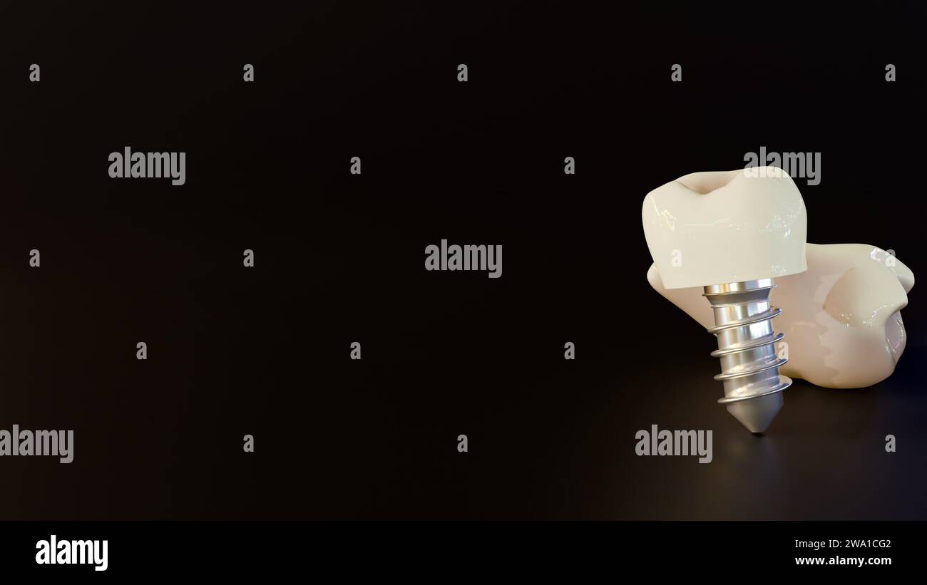3d rendering of healthy human tooth and tooth implant in the black ...
