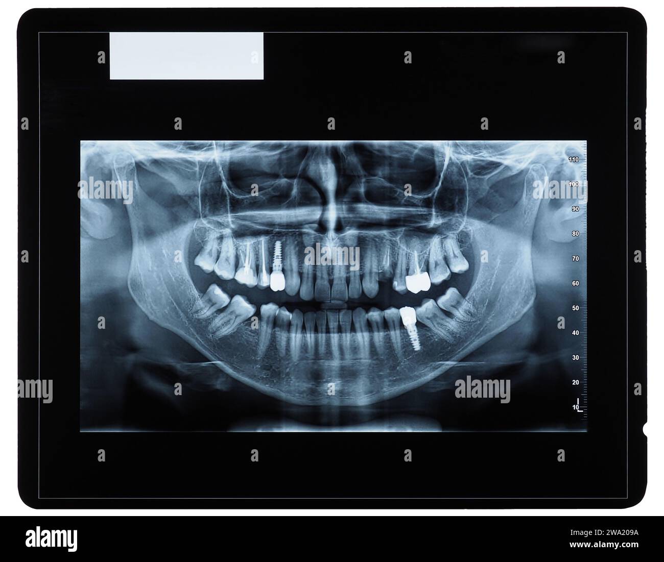 Orthopantomogram Single Panoramic Image Radiograph Of The Mandible ...