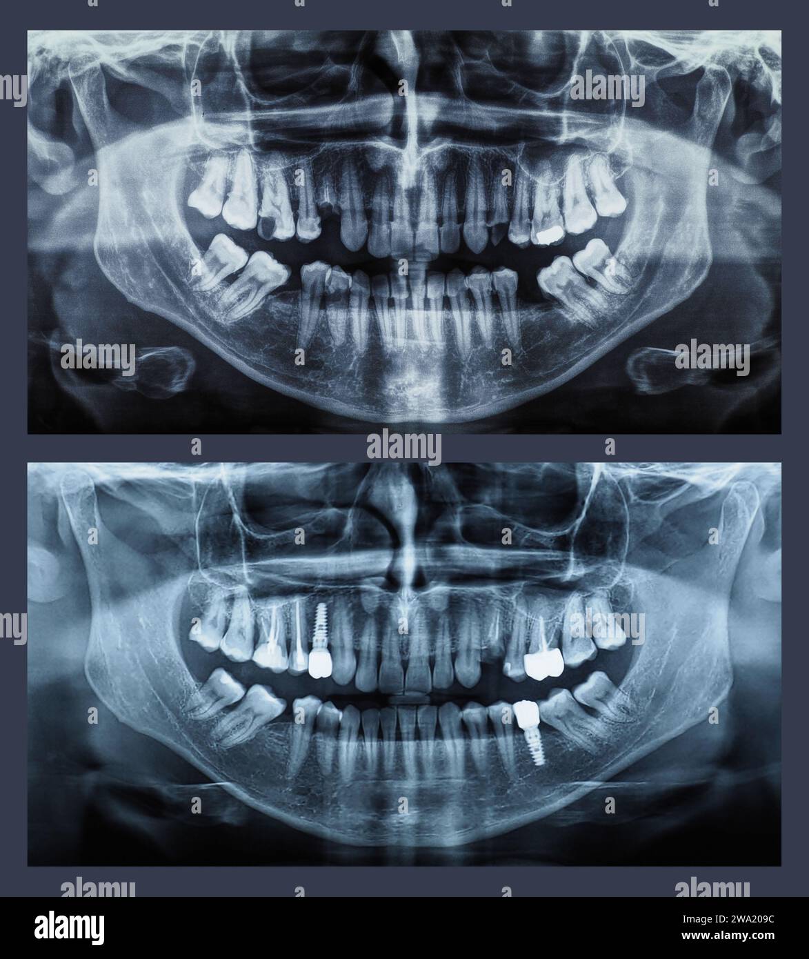 Orthopantomogram Single Panoramic Image Radiograph Of The Mandible ...