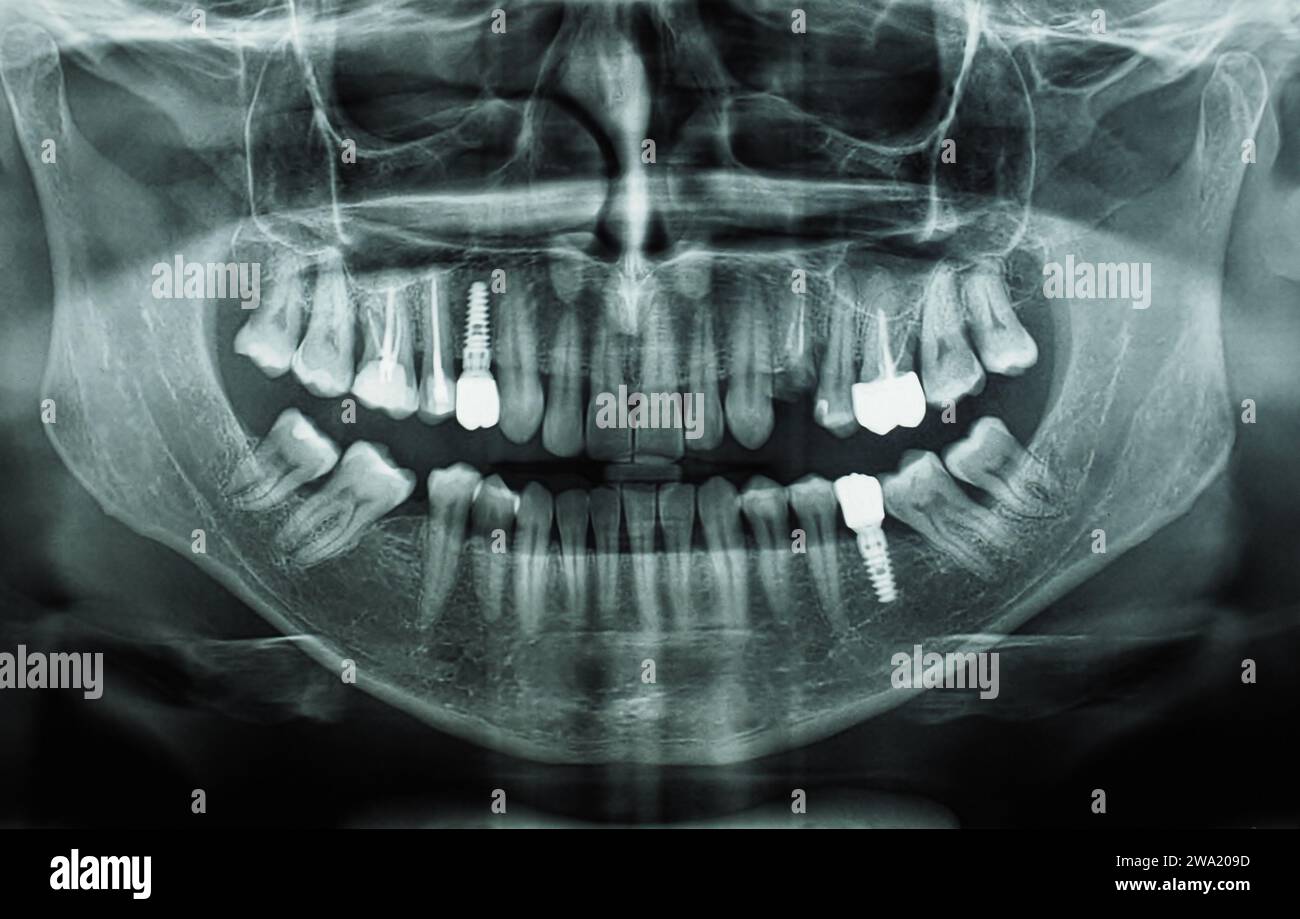 Orthopantomogram Single Panoramic Image Radiograph Of The Mandible ...