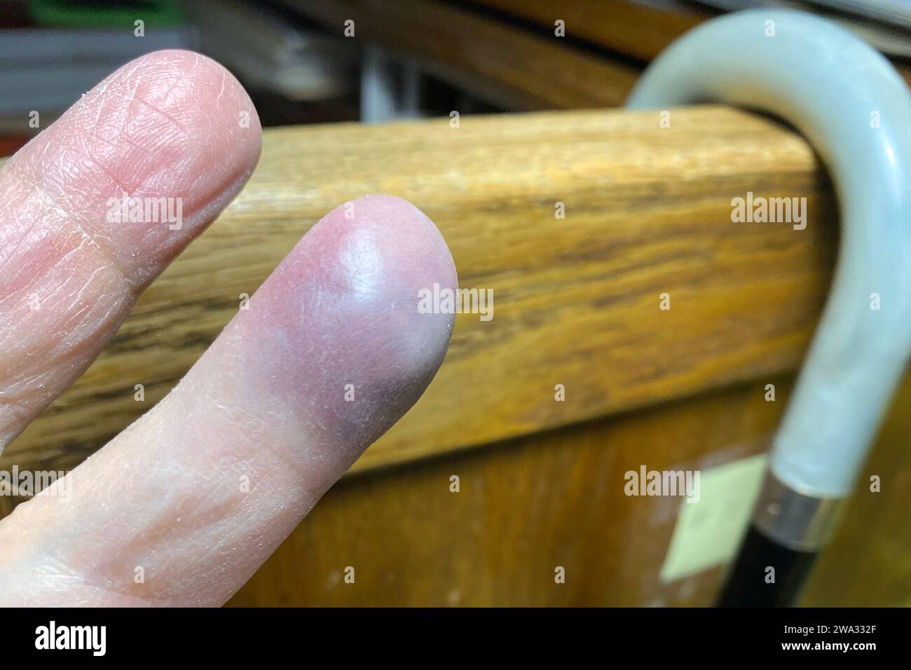 Finger injury hi-res stock photography and images - Alamy