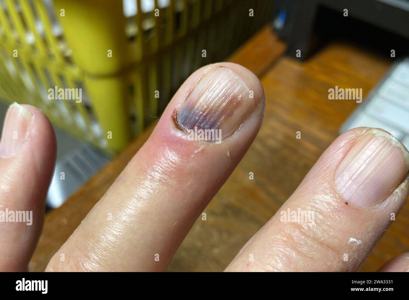 Broken finger hi-res stock photography and images - Alamy