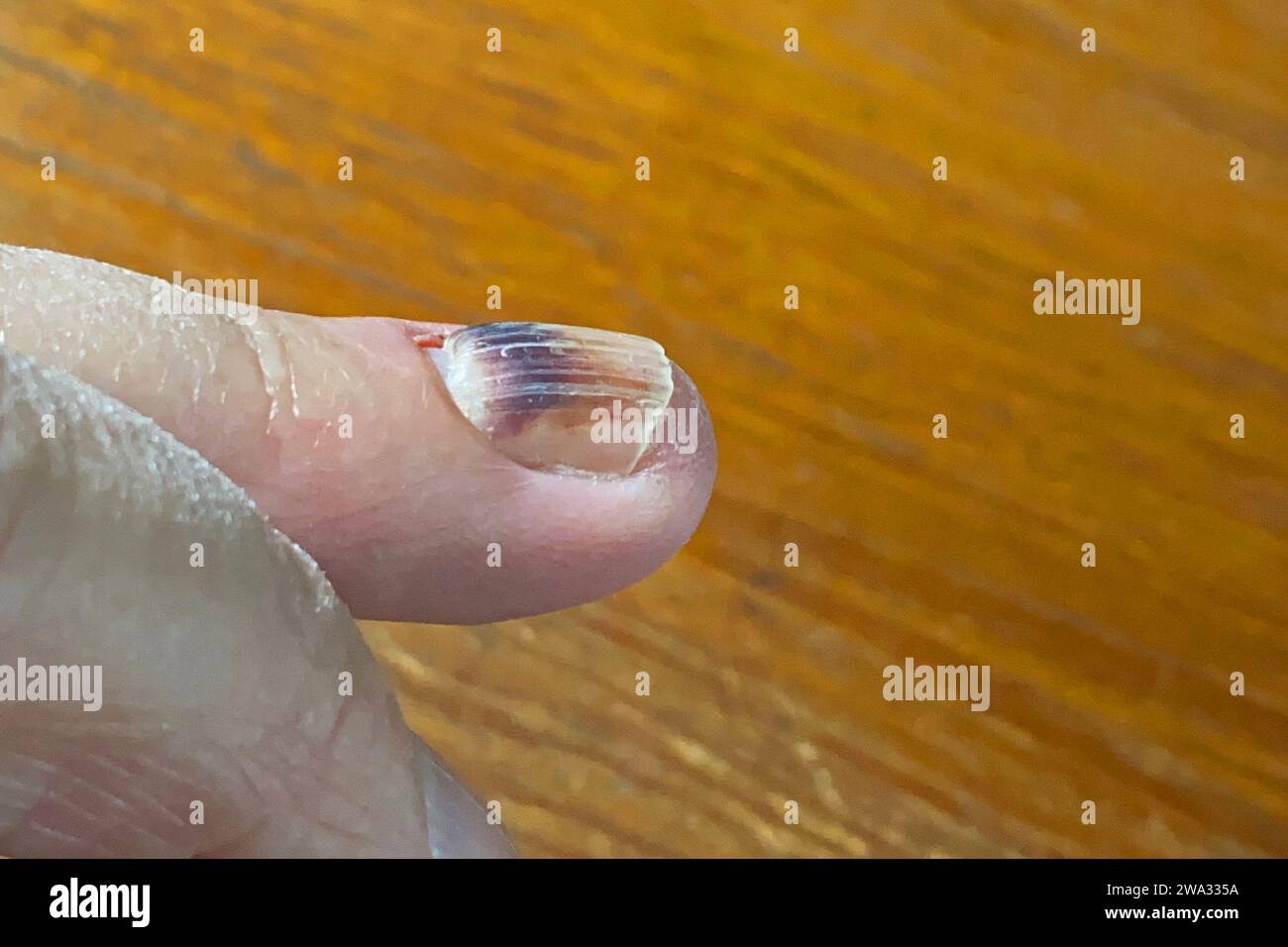Finger bruised hi-res stock photography and images - Alamy