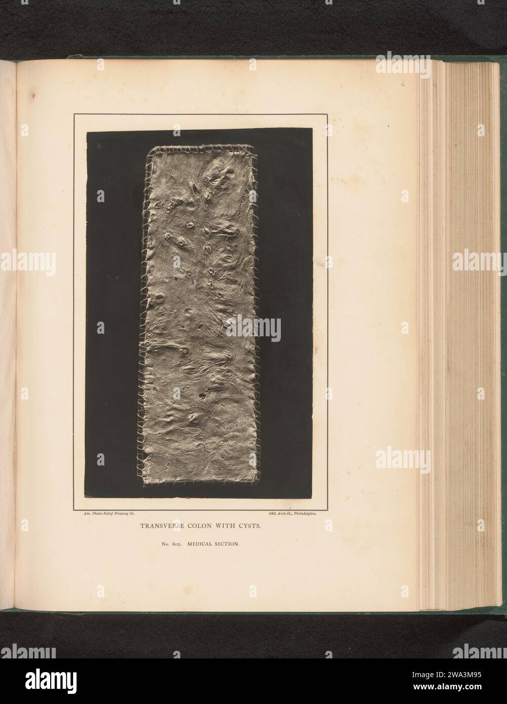 Stretched piece of transverse gut with cysts, E.J. Ward, c. 1874 - in ...