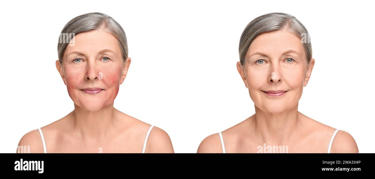 Before and after rosacea treatment. Photos of woman on white background ...