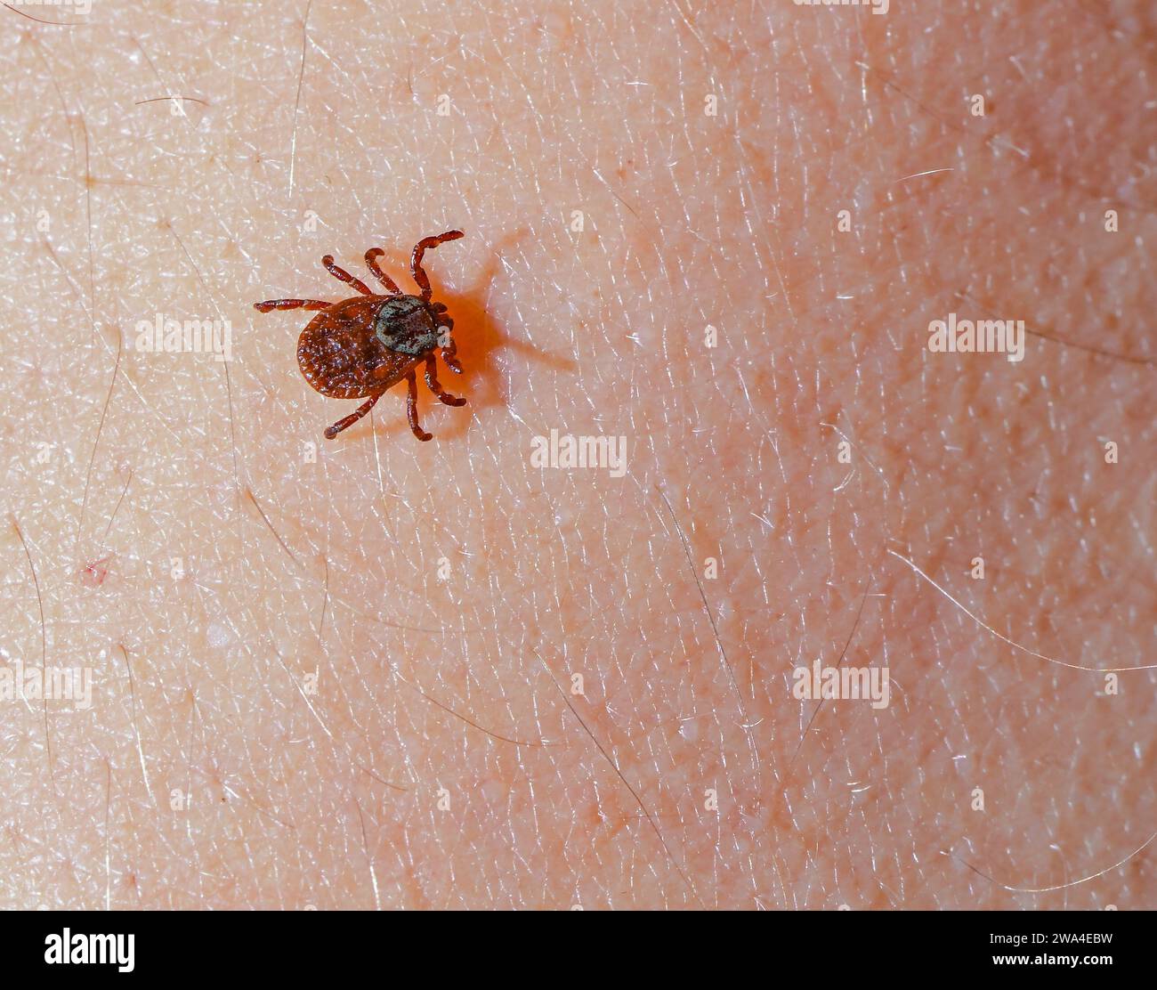 Sieversdorf, Germany. 01st Jan, 2024. A tick (Ixodida) can be seen on the skin of a human ...